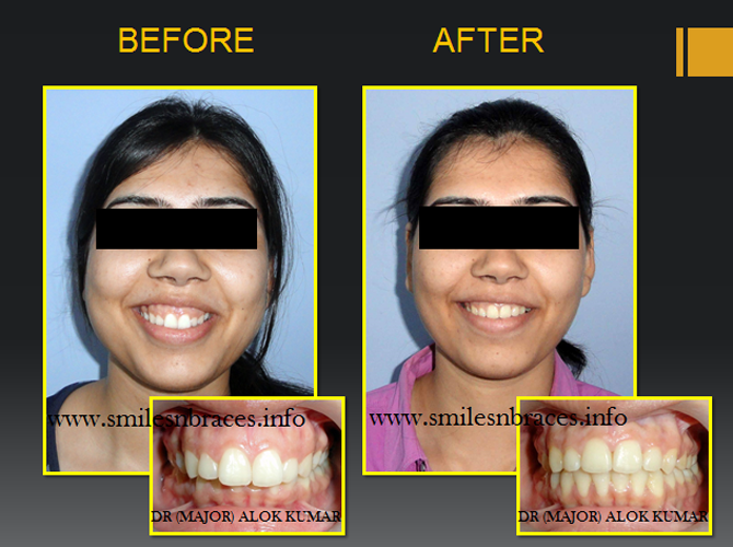 Severe Constriction Of Maxillary Arch Corrected By Orthodontics ...